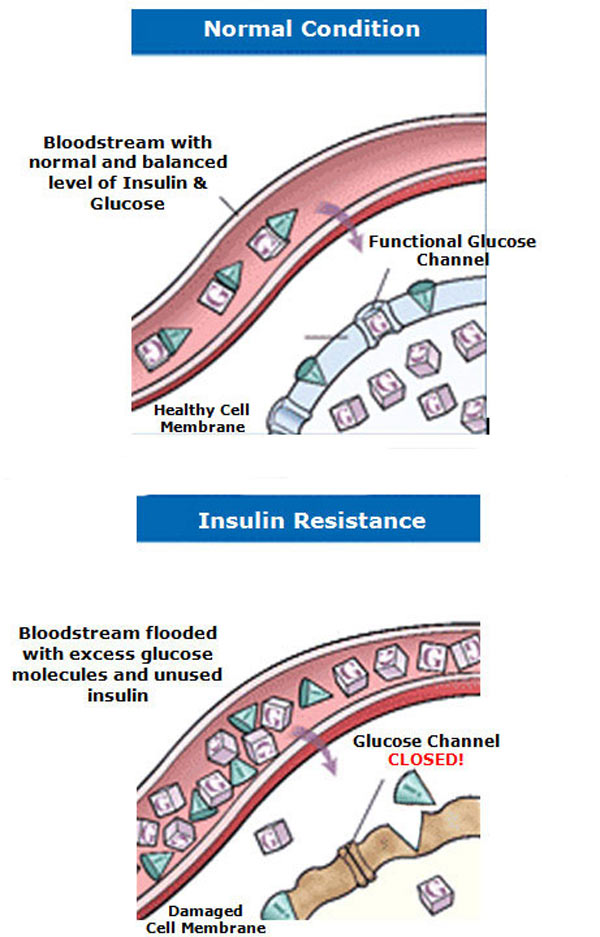 Turning Pre-Diabetes Around: Simple Nutritional Steps
